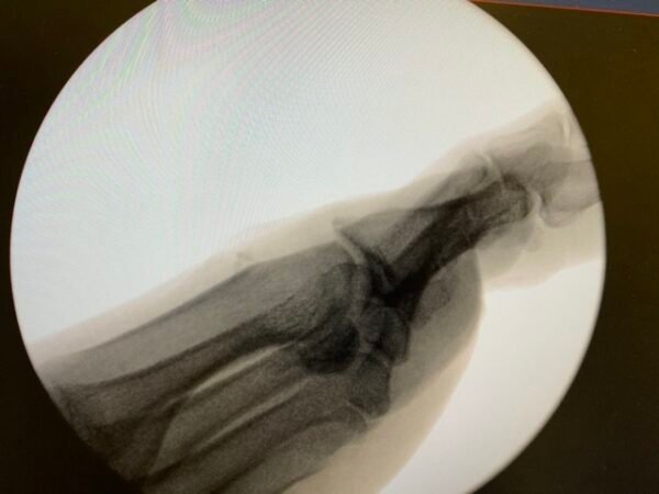 Hallux Limitus Cheilectomy Surgery Recovery 1- HikeIt