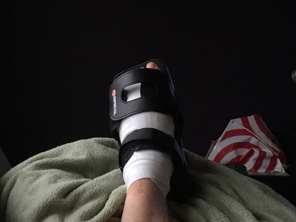 Hallux-limitus-cheilectomy-surgery-overview- HikeIt